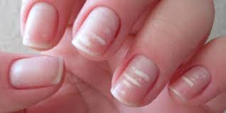 Manchas nas unhas podem ser sinal de problemas de saúde